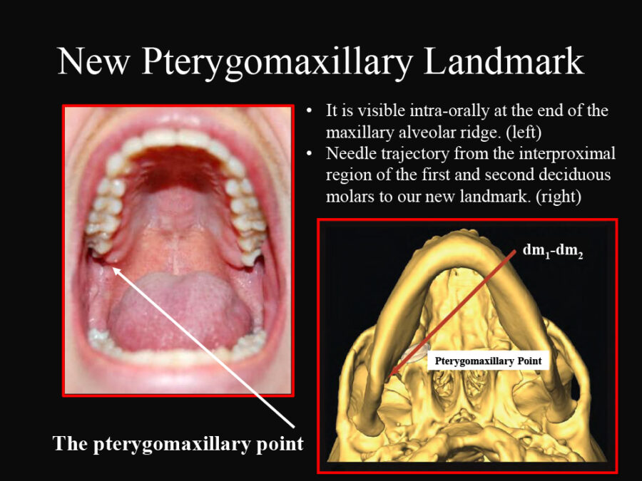 Inferior Alveolar Nerve Block in Pediatric Patients: A Quantitative ...